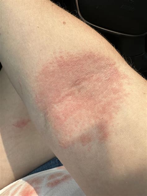 Chronic Hives Rurticaria