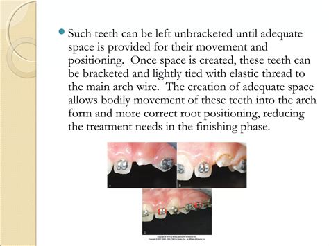 Leveling And Aligning In Orthodontics Ppt