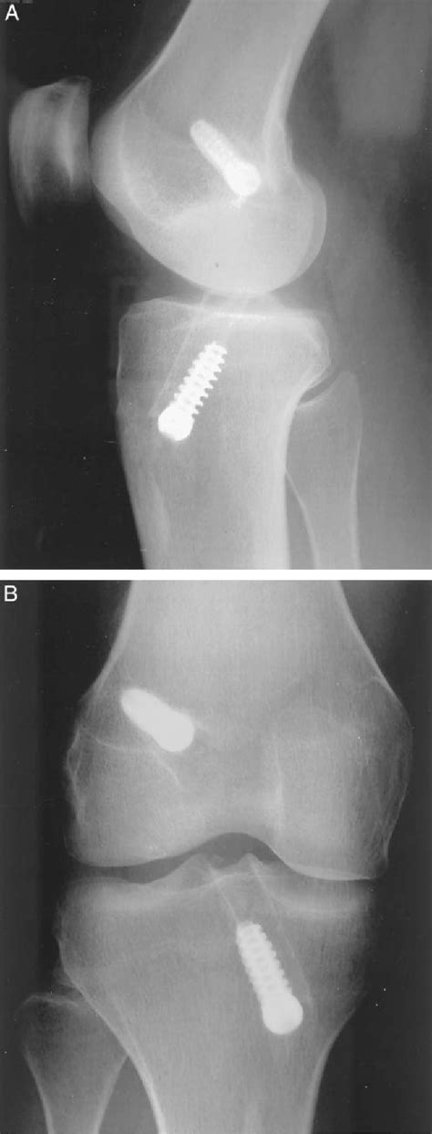 Figure 1 From A Five Year Comparison Of Patellar Tendon Versus Four Strand Hamstring Tendon