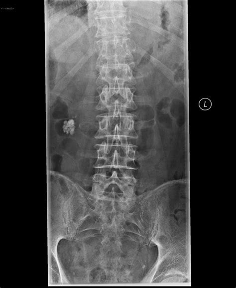 Compression Fracture X Ray
