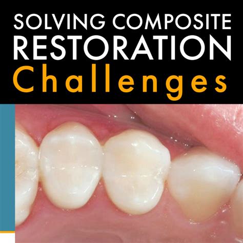 Solving Composite Restoration Challenges S3564 Ce Video Library