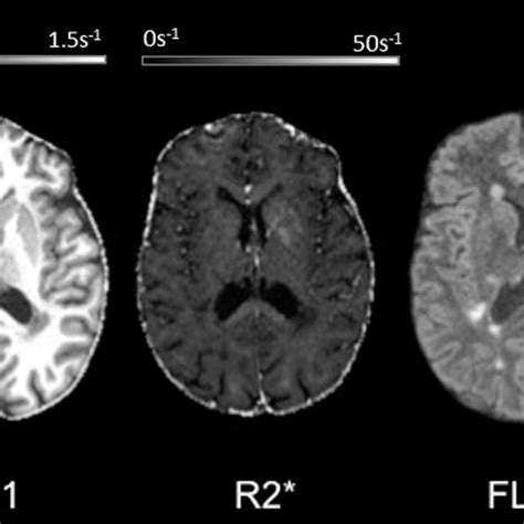 Example Of Mpm Quantitative Maps For A Specific Ms Patient From Left Download Scientific