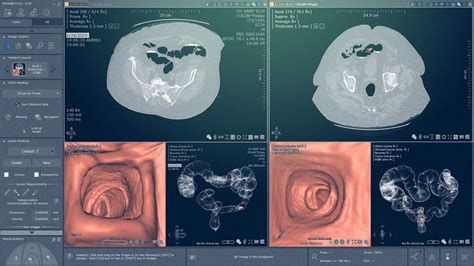 Oncology Software Module Myrian XP Colon Intrasense Endoscopy Analysis Visualization