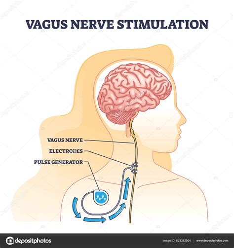 Vagus Nerve Stimulation Medical Device Implant Brain Outline Diagram