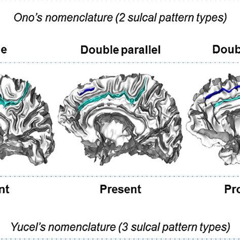 The Different Sulcal Pattern Types Of The Anterior Cingulate Cortex Download Scientific Diagram