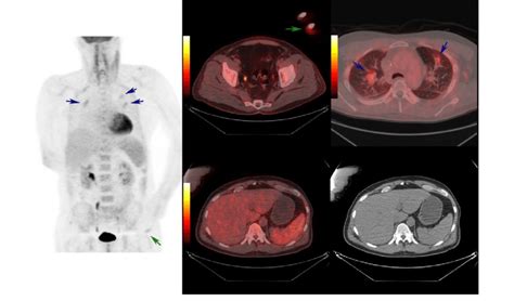 This 48 Year Old Male With Staphylococcal Aortic And Mitral Valve Download Scientific Diagram