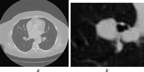 Denoising Results By Rpca A Denoising Image B Partially Enlarged