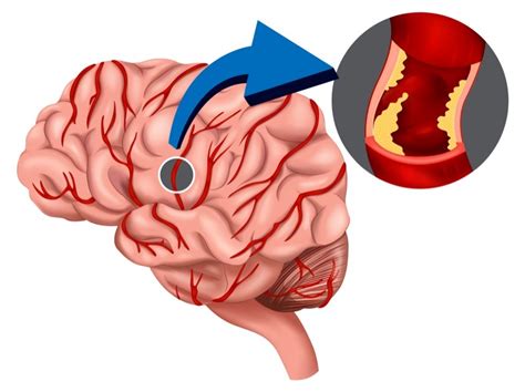 Vascular Dementia Net Health Book