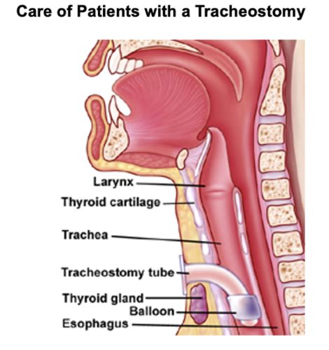 Tracheostomy Flashcards Quizlet