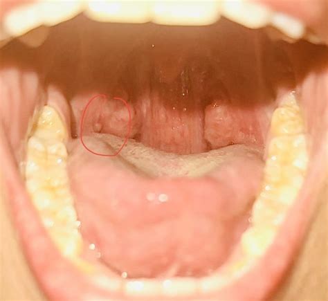 Red Bump On My Tonsil Area Raskdoctorsmeeee