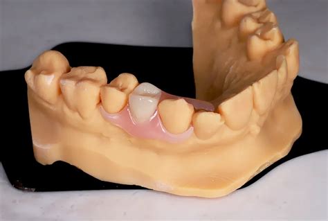 Flexible Partial Dentures Simply Teeth