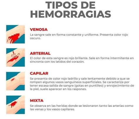 Tipos De Hemorragias Oposiciones Auxiliar De Enfermeria Cosas De