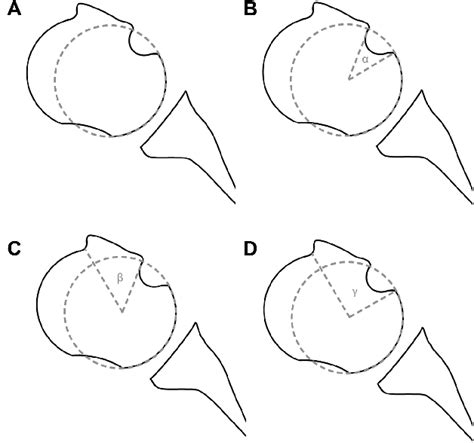 Concomitant Reverse Hill Sachs Lesion And Posterior Humeral🔪 Proteja