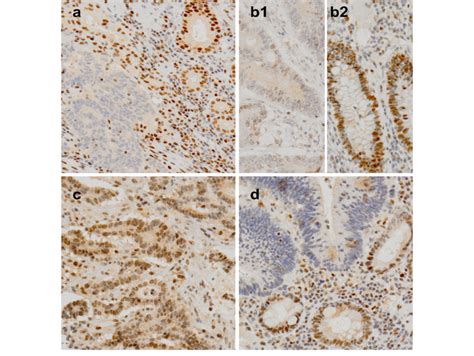 Immunohistochemical Staining Of Mismatch Repair Proteins A Absent Mlh1