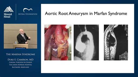 Marfan Syndrome Heart