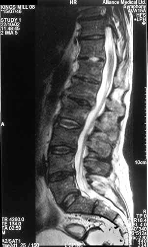 Sagittal T2 Weighted Mri Scan Of The Lumbosacral Spine Showing