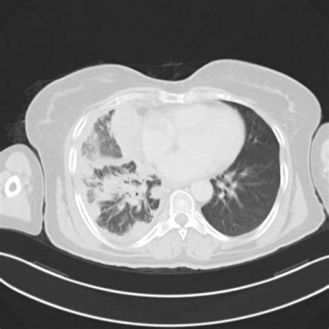 Detection Of Lung Cancer Object Detection Dataset V1 Lungcancer