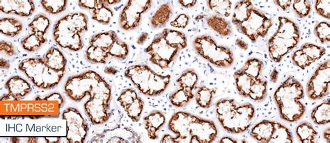 Biogenex On Linkedin Biogenex Prostatecancer Innovationinmedicine Healthcarerevolution…