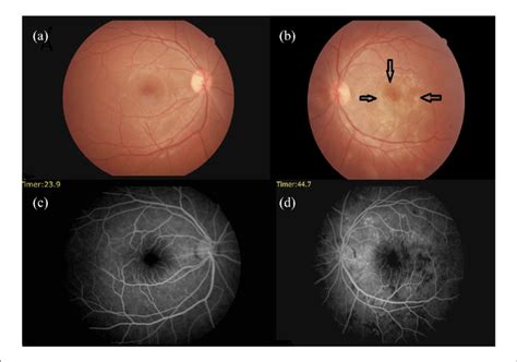 A Image Of The Normal Right Fundus B Choroiditis Foci In Left Download Scientific Diagram