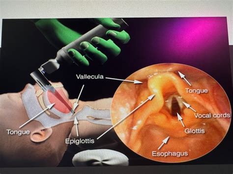Intubation Quiz Flashcards Quizlet