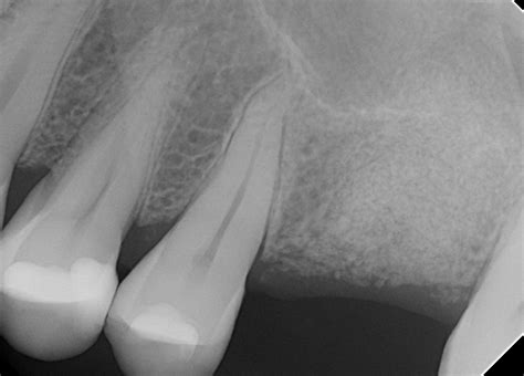 Socket Preservation Dr Jill Levine Toronto Periodontist