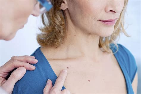IdentificaÇÃo E PrevenÇÃo Do CÂncer De Pele Dermatologista Porto