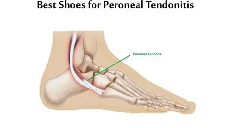 What Is The Peroneal Tendon And What Is Its Use Dr Bijan 4 Feet