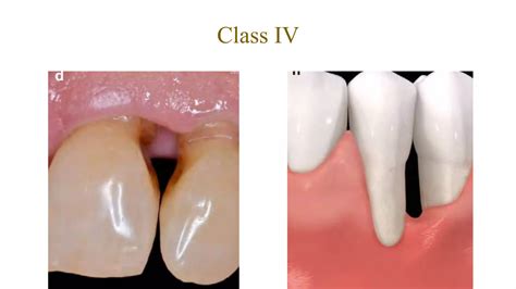 Gingival Recession Type Defects Ppt
