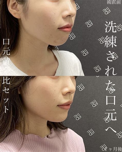 洗練された美しい口元へ 【大人気口元黄金比セット】💎1ヶ月後 Emmo Face Clinic