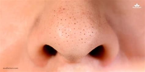 How To Shrink Pores On Nose Pore Fect Solutions