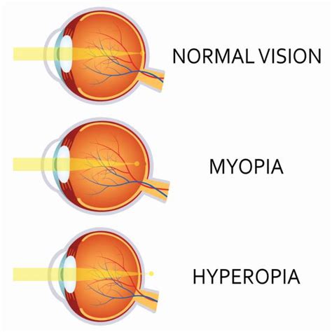 Eyesight Defects Illustrations Royalty Free Vector Graphics And Clip Art Istock