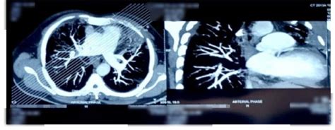 Ctpa Showing A Contrast Filling Defect In The Posterior Basal Segmental