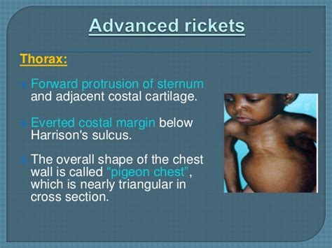 Harrison S Sulcus