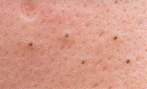 Deep Blackheads Rskincareaddiction