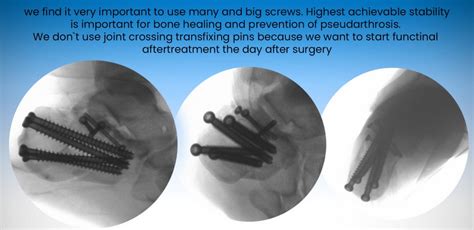 Calcaneal Fracture Comminuted Minimal Invasive Treatment Of Calcaneal