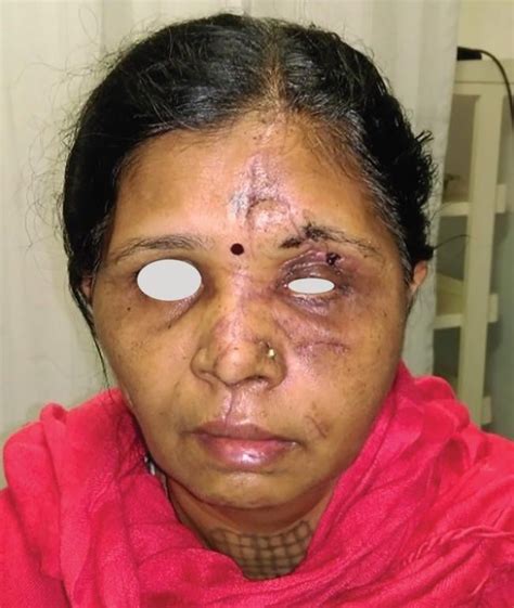 Facial Avulsion Rmedicalgore