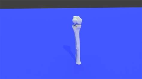 Tibia Tumor Right Sagittal Stl File Processed Democratiz3d