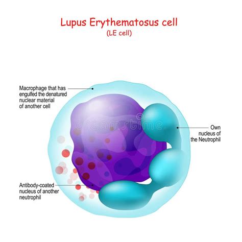 Systemic Lupus Erythematosu Stock Vector Illustration Of Labeled