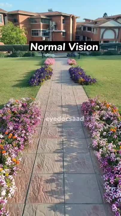 Dr Muhammad Saad On Linkedin Eyehealth Eyehealthtips Ophthalmology
