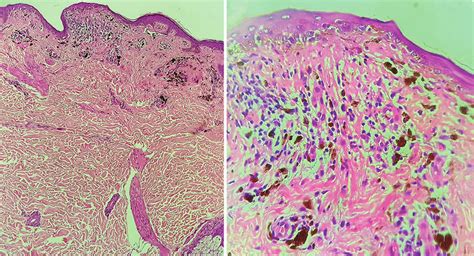 A Epidermal Atrophy Basal Vacuolar Degeneration And Apoptotic