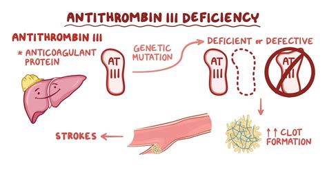 Antithrombin Iii Deficiency Video And Anatomy Osmosis