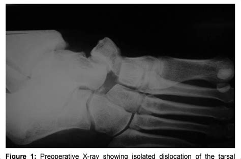 Figure 1 From Isolated Dislocation Of The Tarsal Navicular Without Fracture Case Report