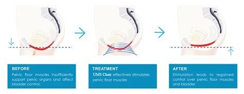 Rectum Ems Urinary Incontinence Device Lifting Bladder Hip Trainer 50hz