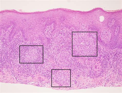Histological Section Of Lower Lip Lesion On Medium Power Tight