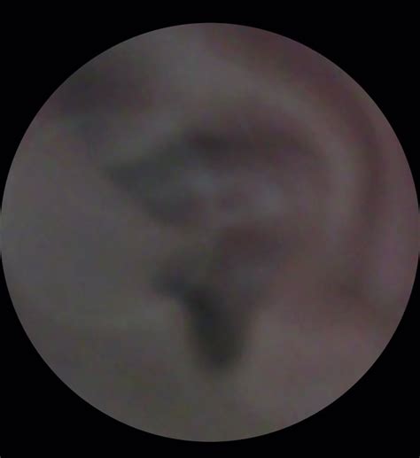 This Is What Your Eardrum Looks Like When You ‘pop It Not Puncture