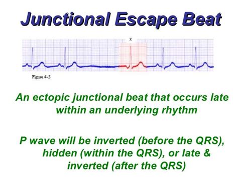 Junctional Escape Rhythm