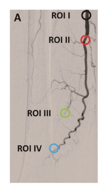 A 57 Year Old Patient With Pad Rutherford 3 Pad Classification And An