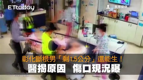 彰化斷根男「剩15公分」還能生！醫揭原因 傷口現況曝 Youtube