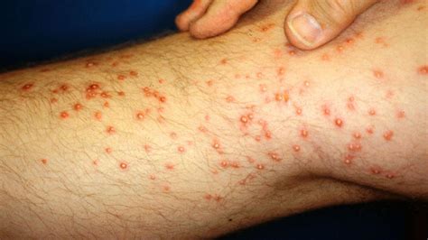 Ant Bites Symptoms Treatments Prevention And More