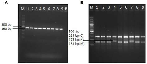 Pcr Rflp Analysis Of Hb Adana Location On α2 Globin Gene A Undigested